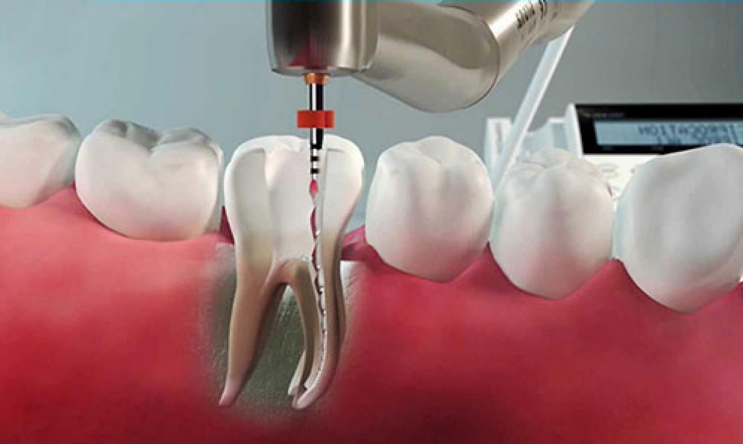 Root Canal Treatment Forde Dental Root Canal Treatment Forde Dental